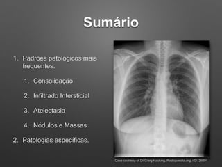 Monitoria Patologias Pulmonares na Radiografia Simples de Tórax | PPTX