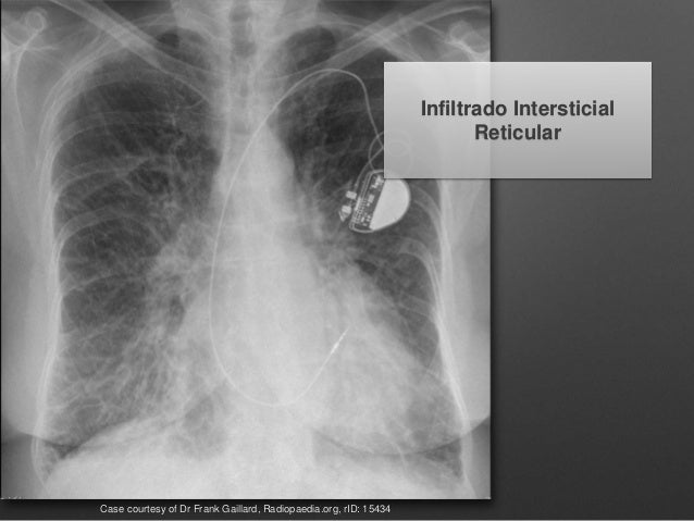 Monitoria Patologias Pulmonares na Radiografia Simples de Tórax