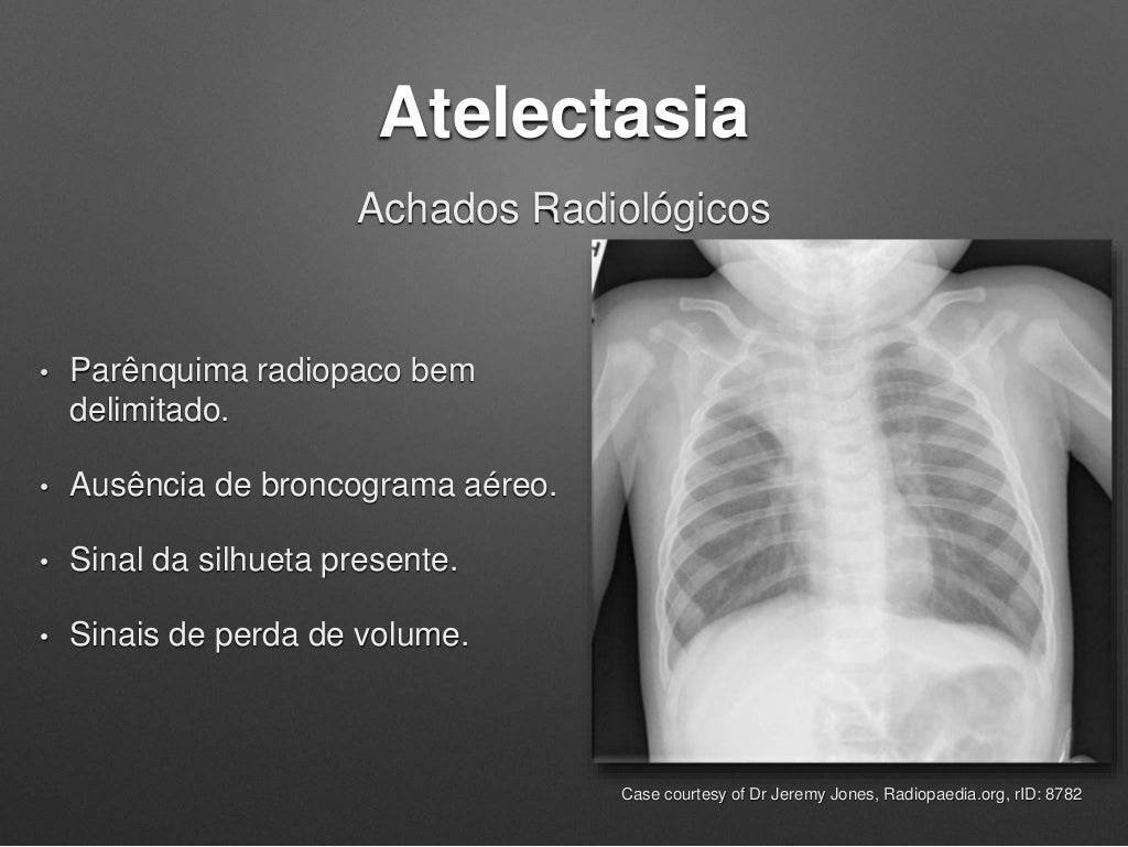 Monitoria Patologias Pulmonares na Radiografia Simples de Tórax