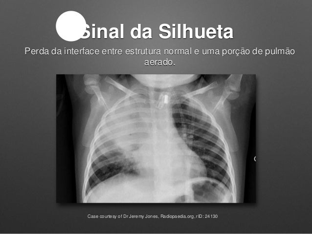 Monitoria Patologias Pulmonares na Radiografia Simples de Tórax