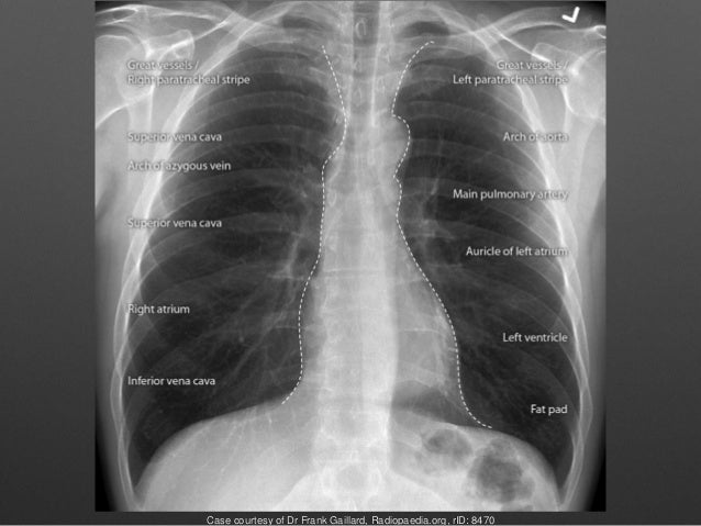 Monitoria Patologias Pulmonares na Radiografia Simples de Tórax