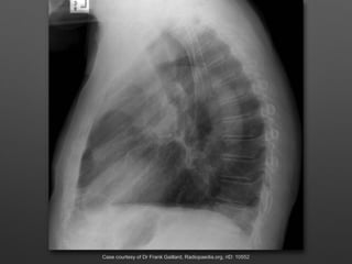 Monitoria Radiografia de Tórax - Manifestações Patológicas Pulmonares ...