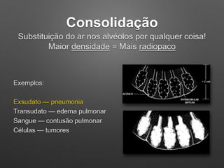 Monitoria Radiografia de Tórax - Manifestações Patológicas Pulmonares ...