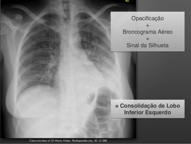 Monitoria Radiografia de Tórax - Manifestações Patológicas Pulmonares