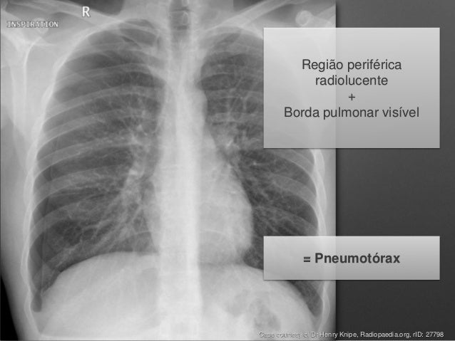 Monitoria Radiografia de Tórax - Manifestações Patológicas Pulmonares