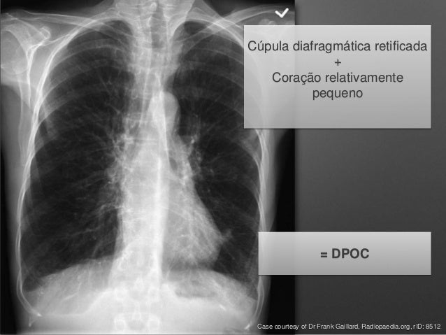 Monitoria Radiografia de Tórax - Manifestações Patológicas Pulmonares