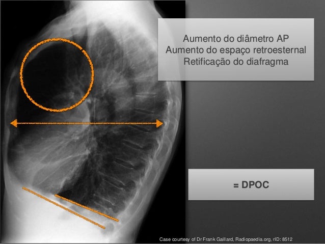 Monitoria Radiografia de Tórax - Manifestações Patológicas Pulmonares