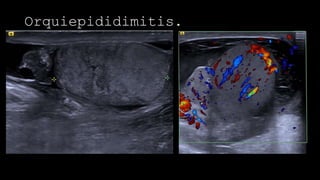 PATOLOGIA TESTICULAR POR DIAGNOSTICO POR IMAGENES.pptx