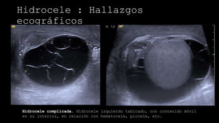 PATOLOGIA TESTICULAR POR DIAGNOSTICO POR IMAGENES.pptx