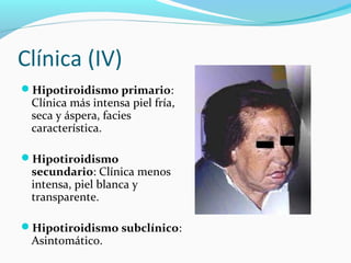 Patología tiroidea en ap | PPT