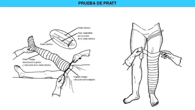 Patologia venosa de miembros inferiores