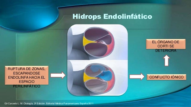 Patologia Vestibular Periférica Endolaberintica