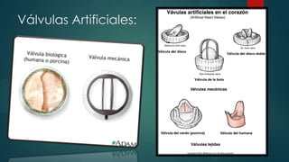 Cardiopatia Isquemica, Hipertensiva y Valvular. | PPTX