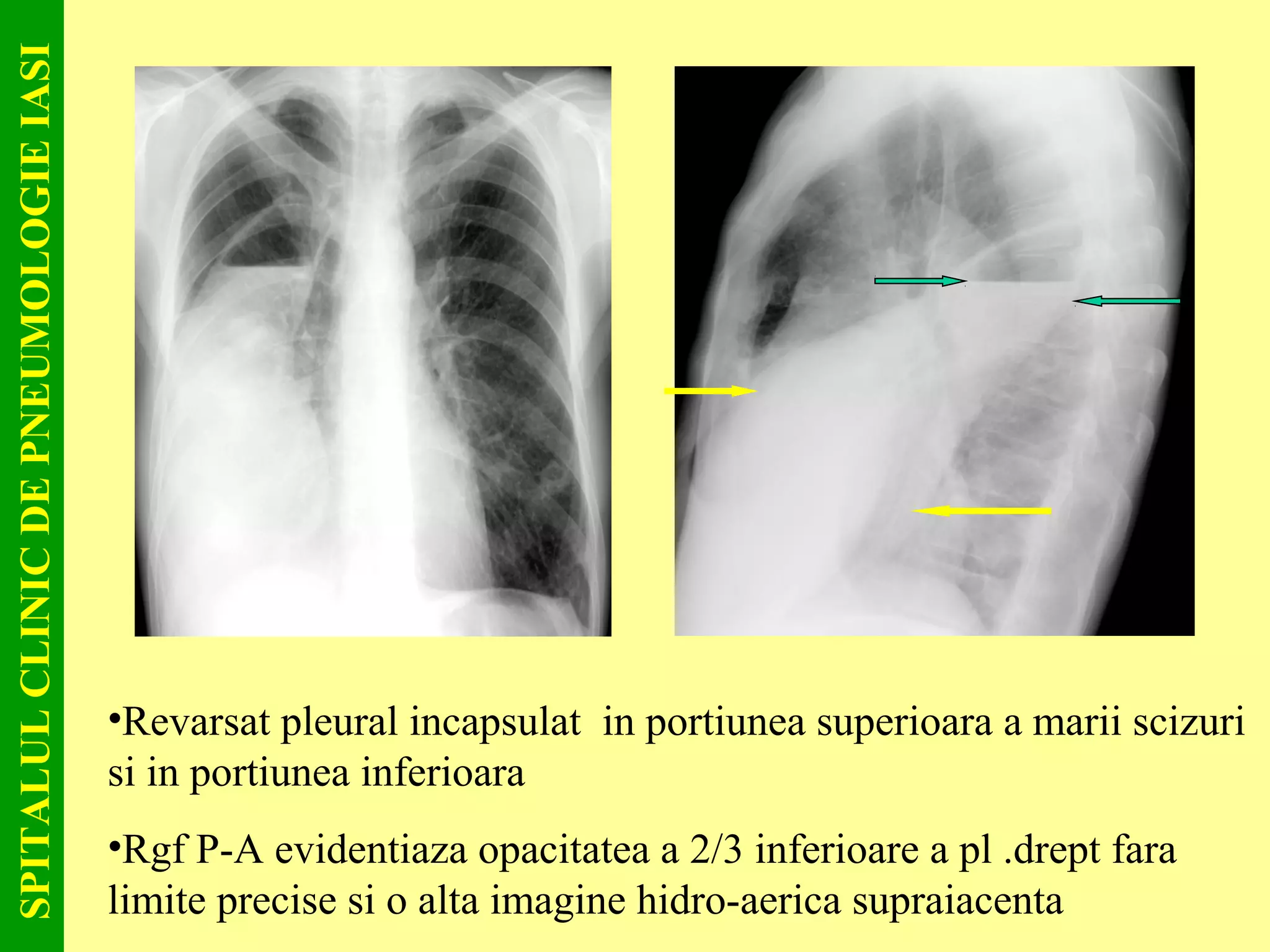 Patologie pleurala mihaescu | PPT