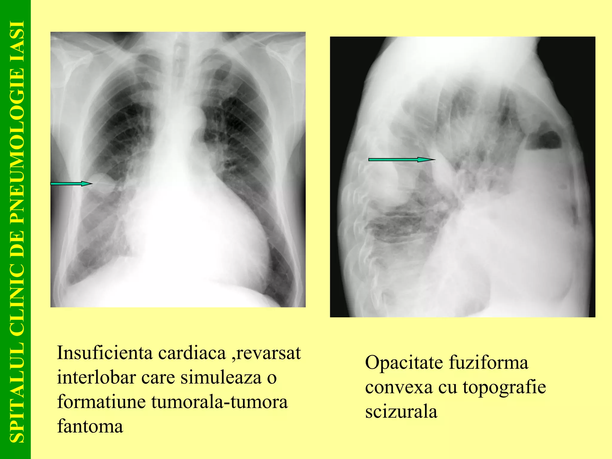 Patologie pleurala mihaescu | PPT