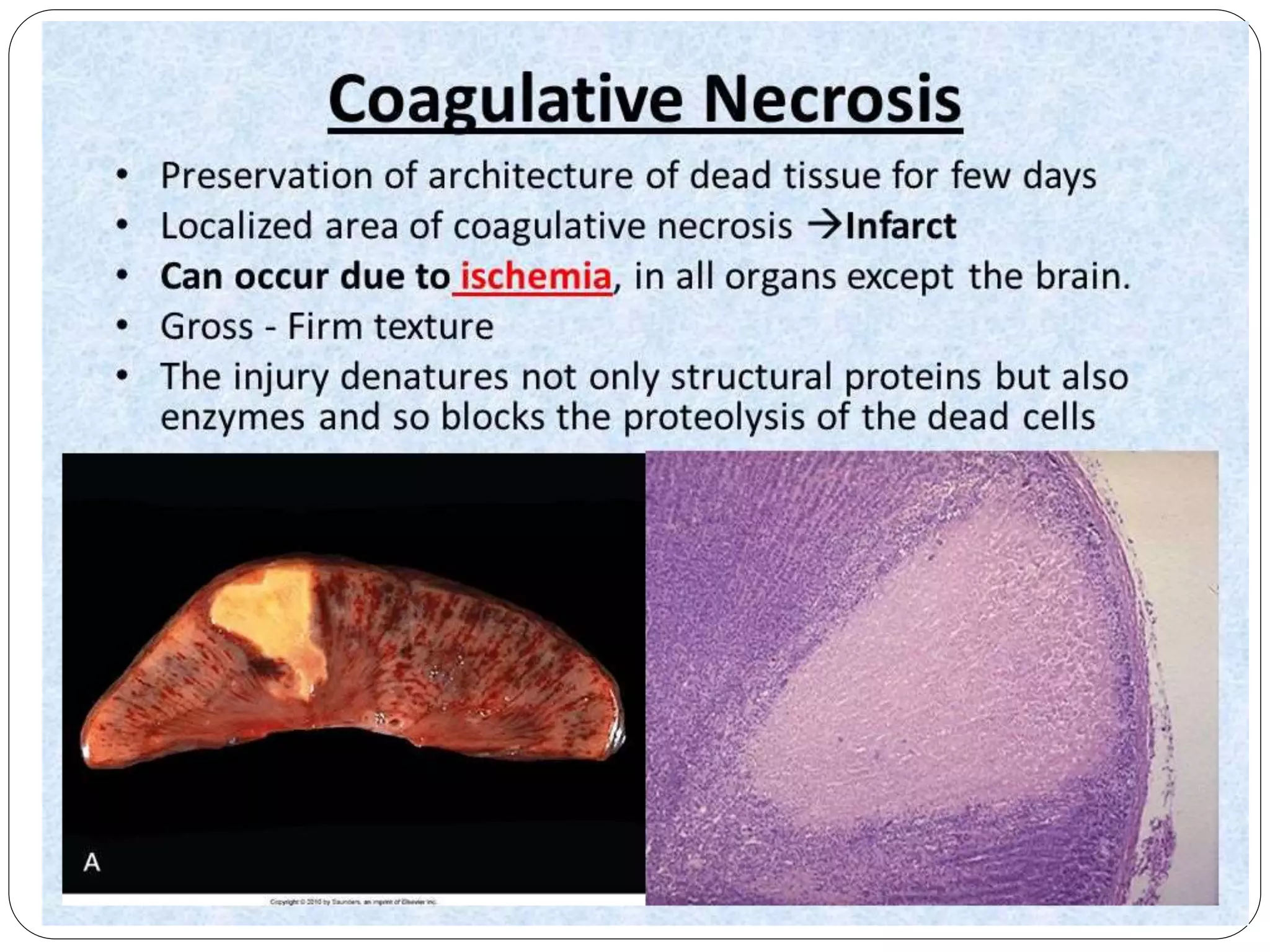 GENERAL PATHOLOGY OF CELL DEATH OF NECROSİS. | PPT