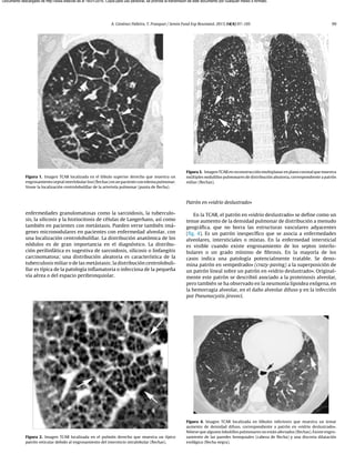Patrones radiologicos en la enfermedad pulmonar intersticial | PDF
