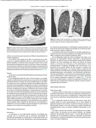 Patrones radiologicos en la enfermedad pulmonar intersticial | PDF