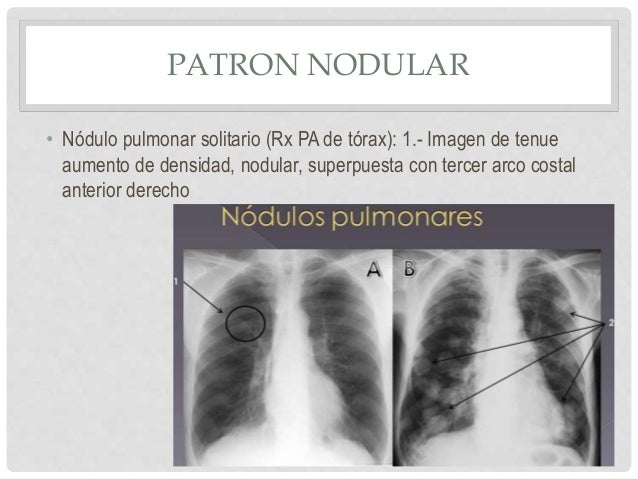Tac Torax Patron Nodular