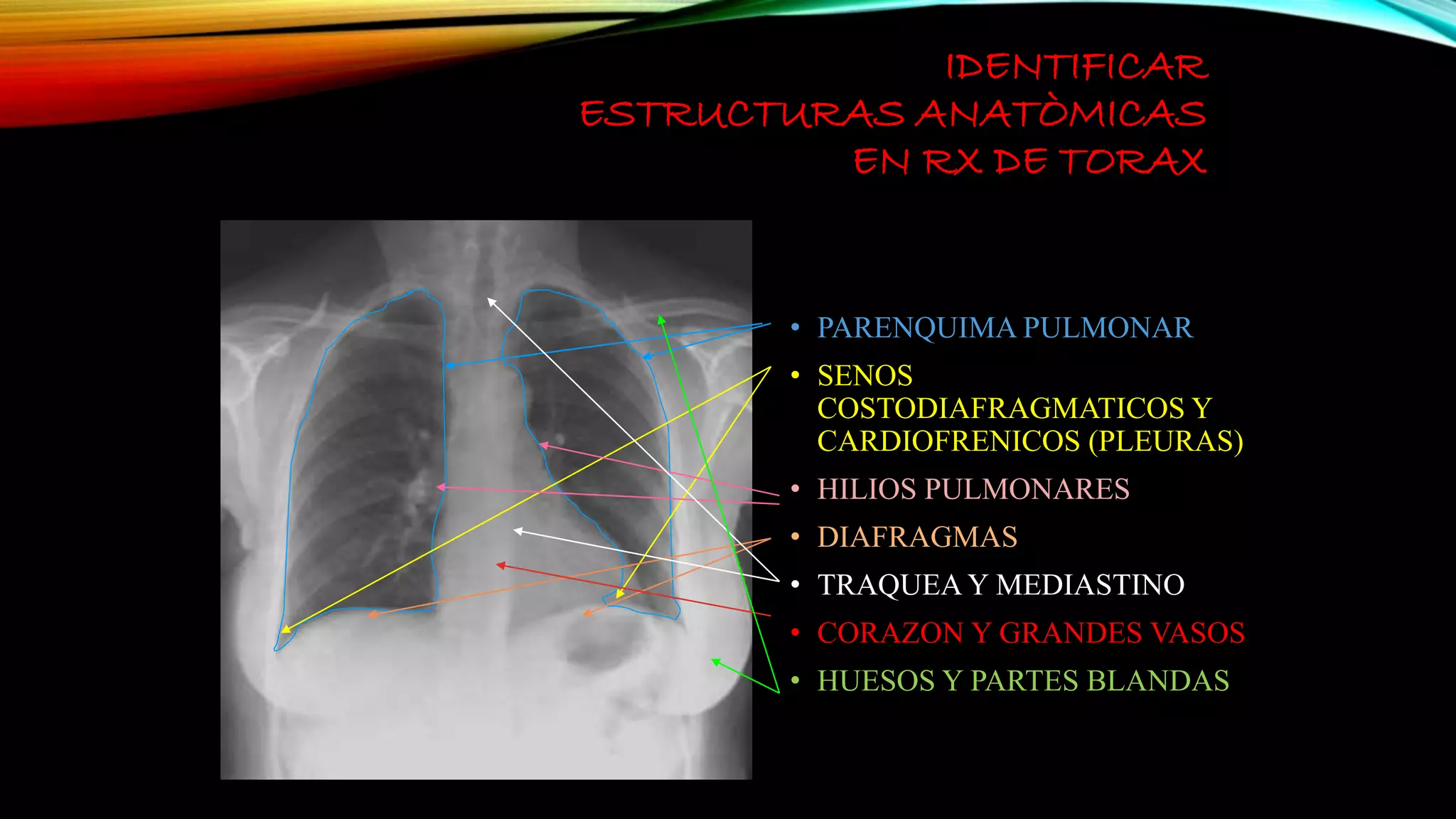 Patrones radiográficos pulmonares rx tcar | PPT