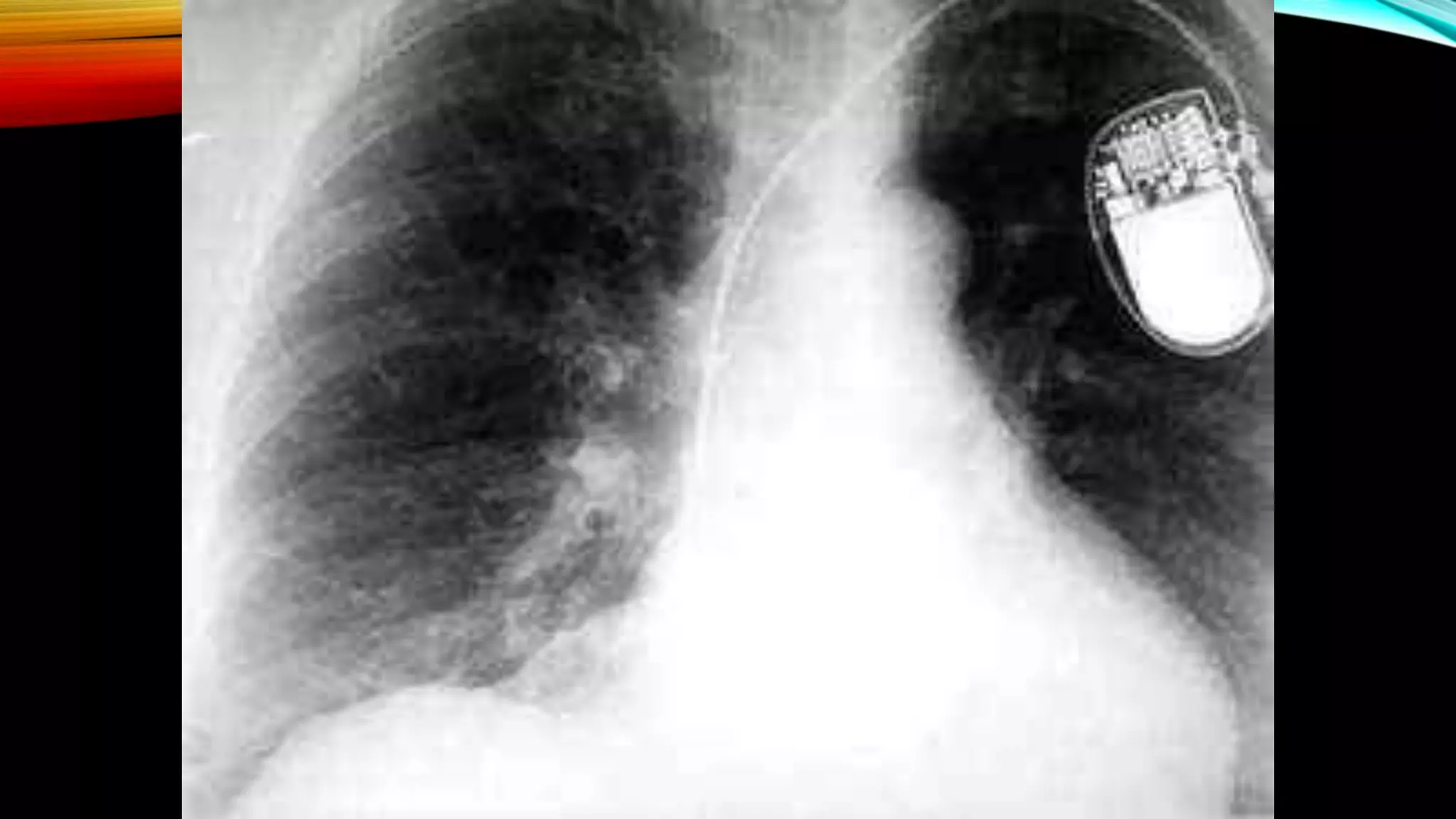 Patrones radiográficos pulmonares rx tcar | PPT