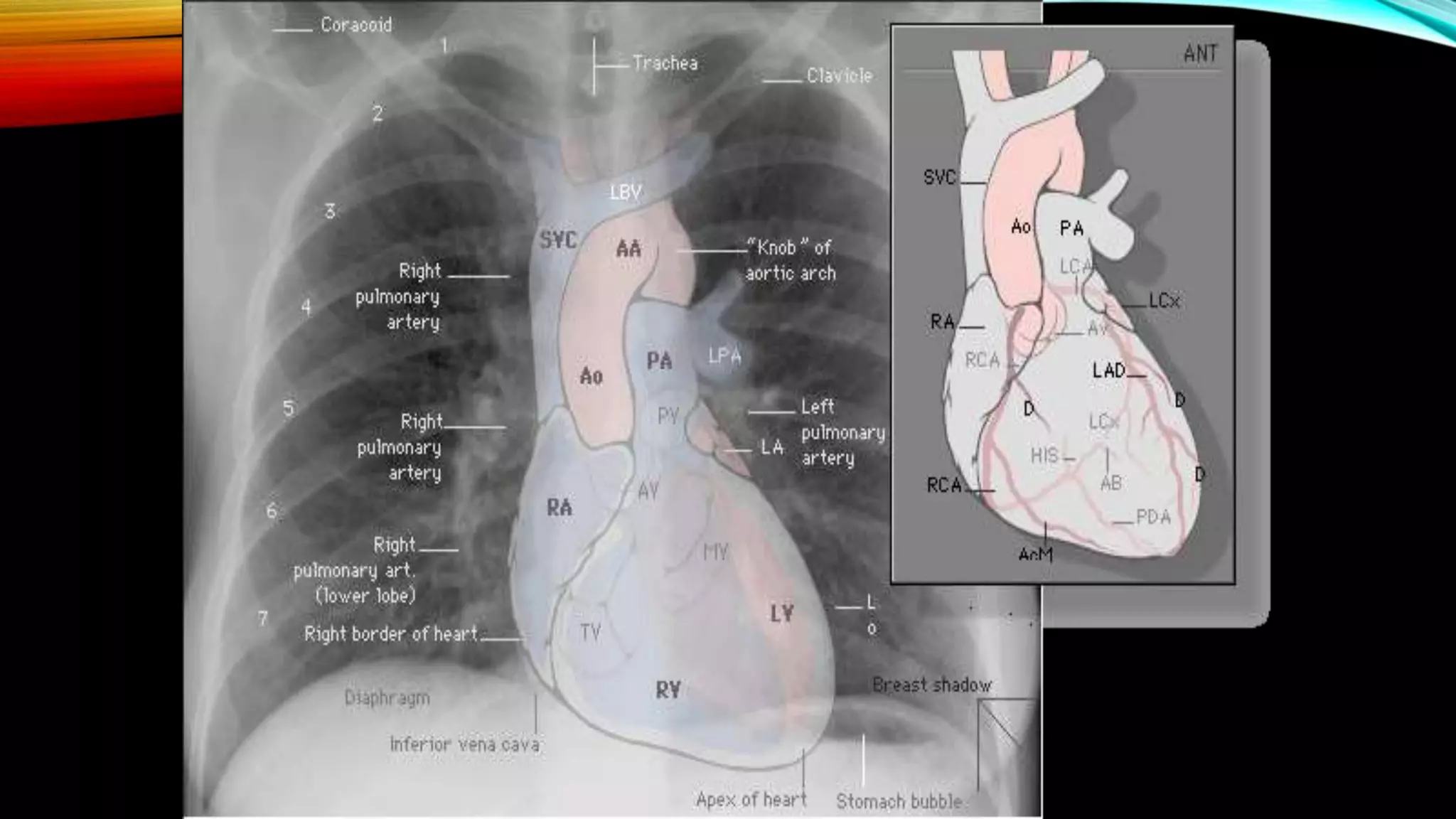 Patrones radiográficos pulmonares rx tcar | PPT
