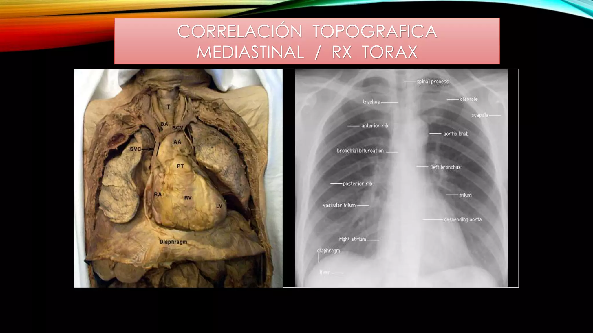 Patrones radiográficos pulmonares rx tcar | PPT