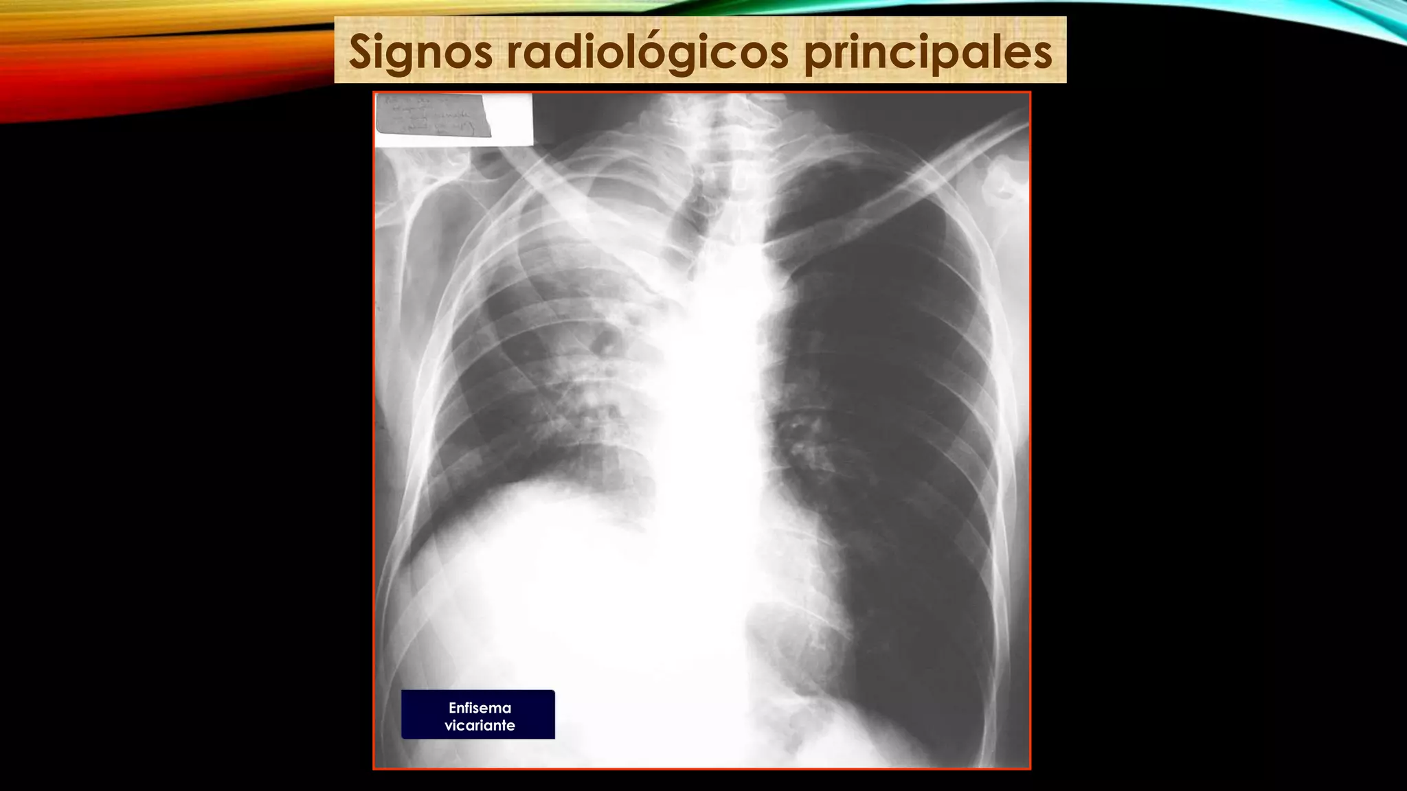 Patrones radiográficos pulmonares rx tcar | PPT