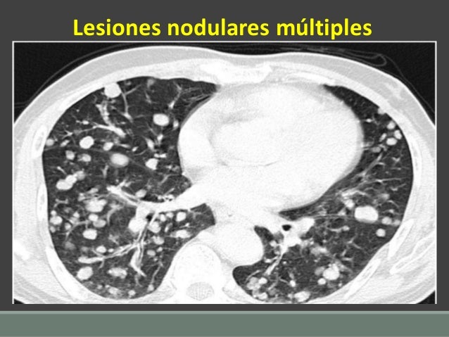 Patrones radiológicos pulmonares un acercamiento diagnóstico