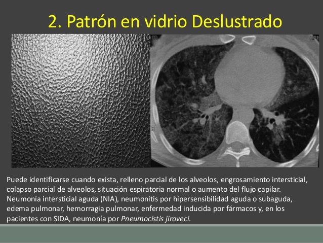 Patrones radiológicos pulmonares un acercamiento diagnóstico