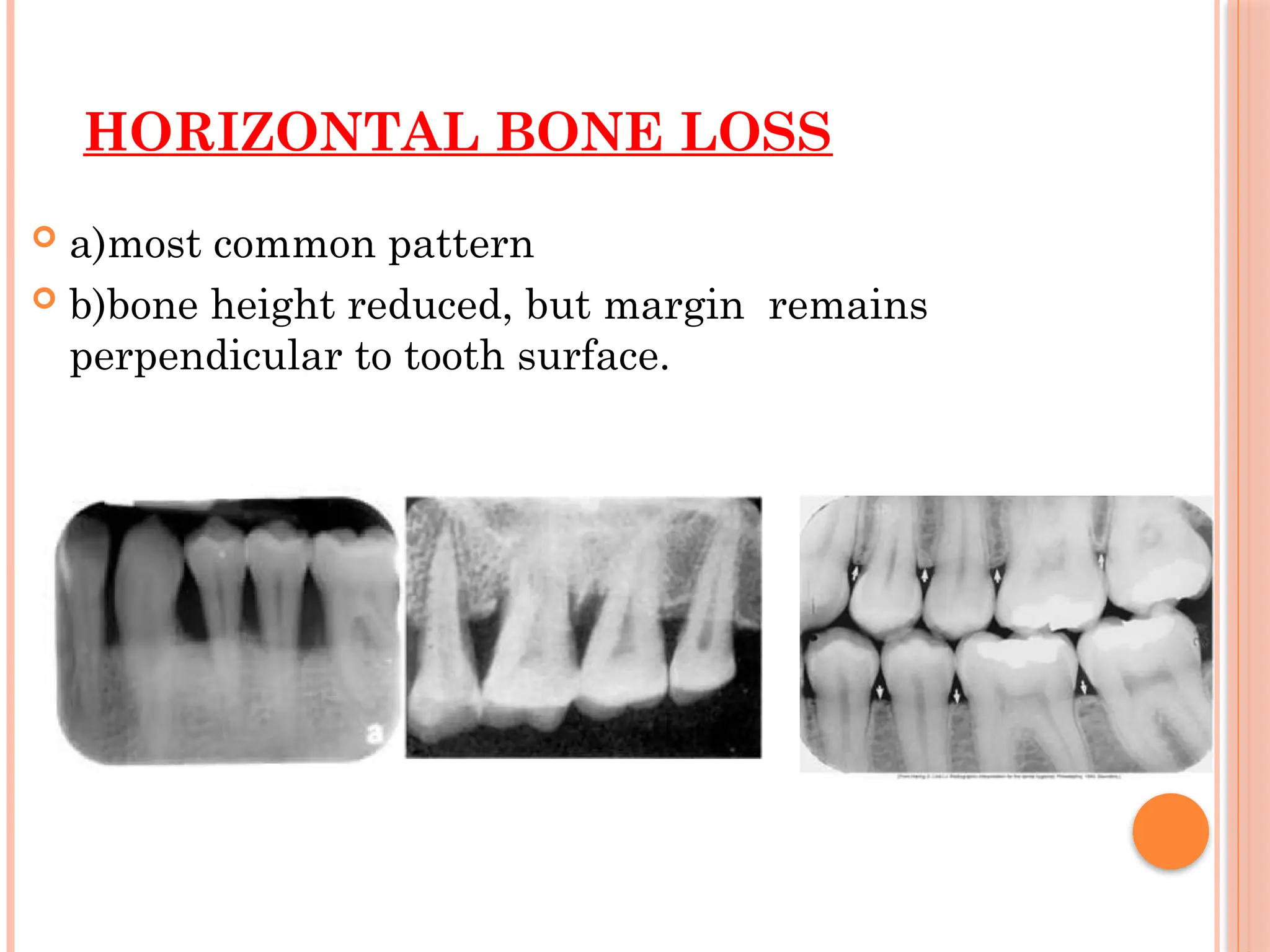 Bone loss and pattern of bone destruction .pptx