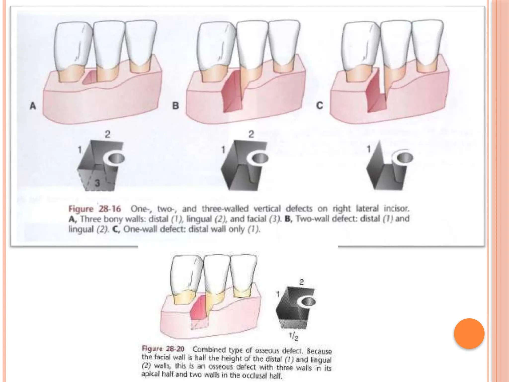 Bone loss and pattern of bone destruction .pptx