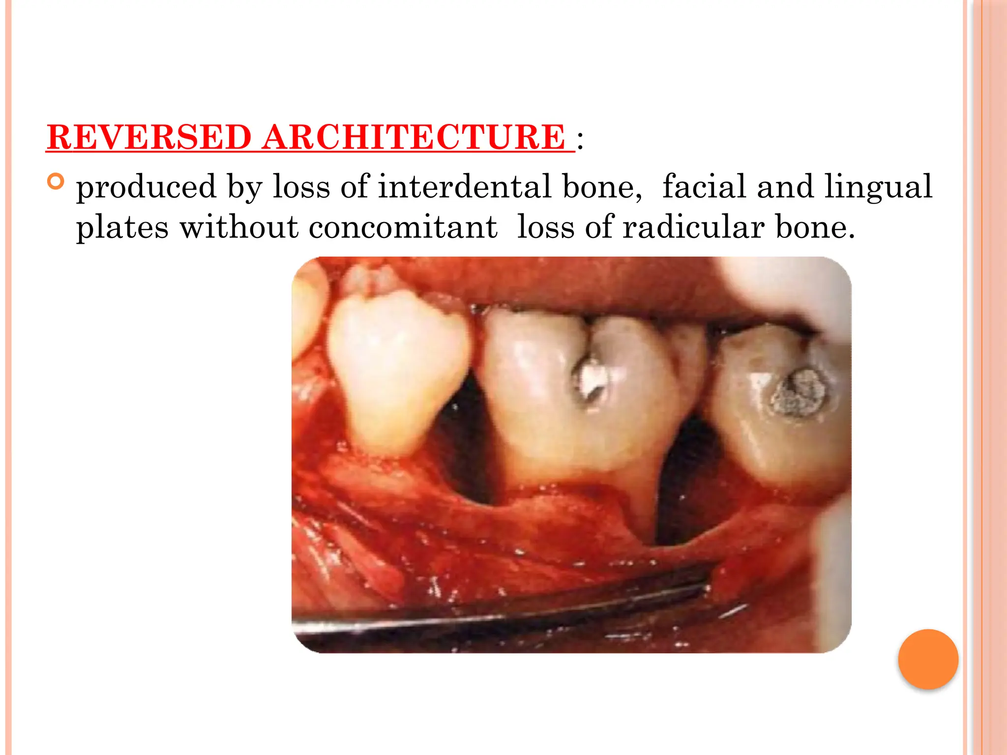 Bone loss and pattern of bone destruction .pptx