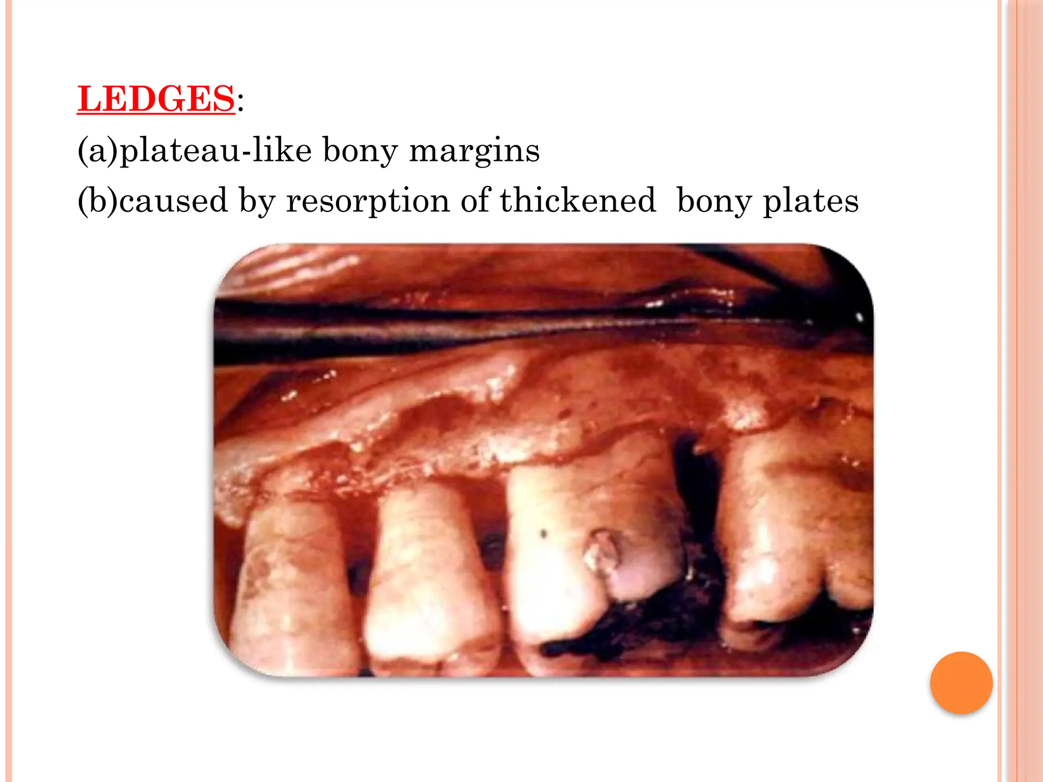 Bone loss and pattern of bone destruction .pptx