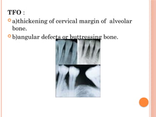 Bone loss and pattern of bone destruction .pptx | Bone and Joint ...