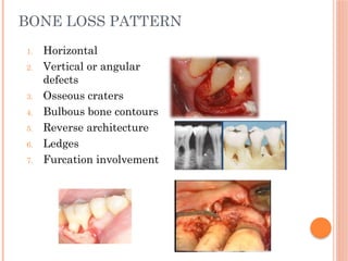Bone loss and pattern of bone destruction .pptx