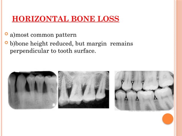 Bone loss and pattern of bone destruction .pptx