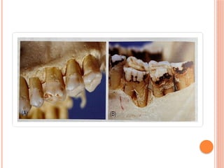 Bone loss and pattern of bone destruction .pptx