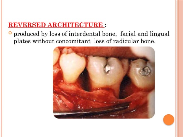 Bone loss and pattern of bone destruction .pptx