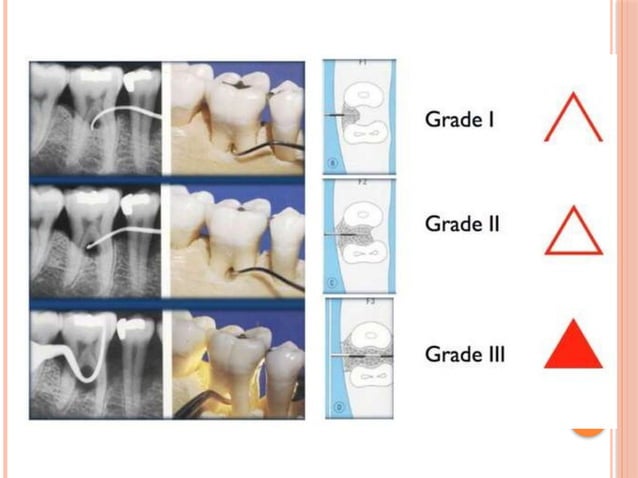 Bone loss and pattern of bone destruction .pptx