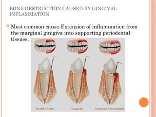 Bone loss and pattern of bone destruction .pptx