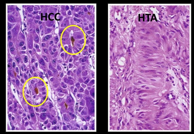 Patterns in histopathology | PPTX | Lung and Respiratory Health ...