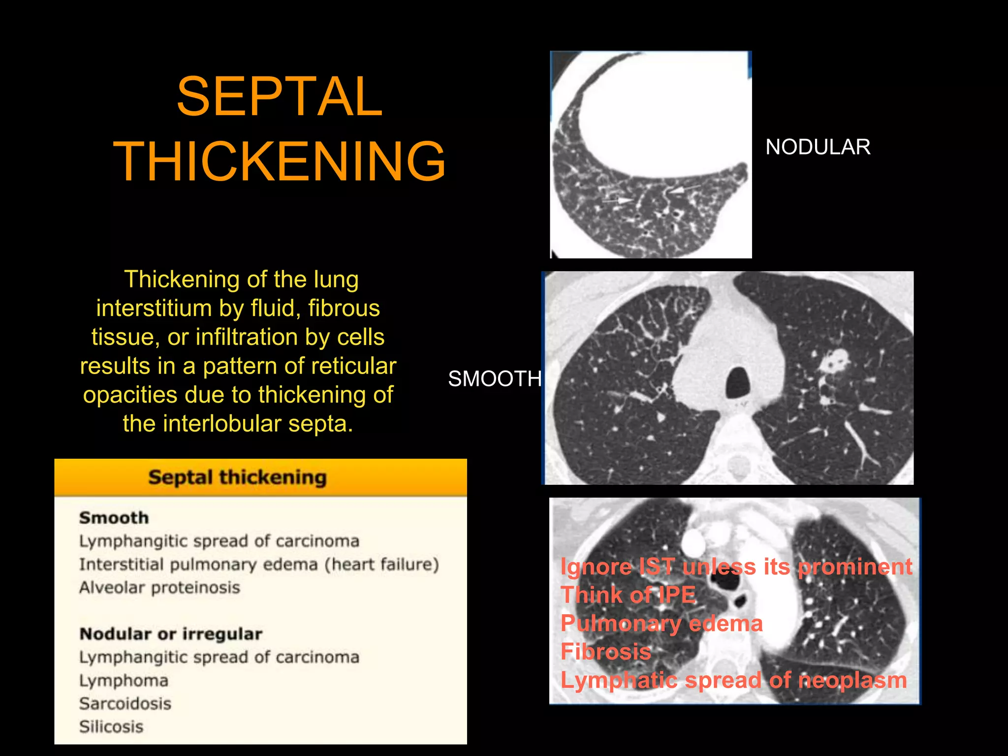 Patterns in HRCT chest | PPTX