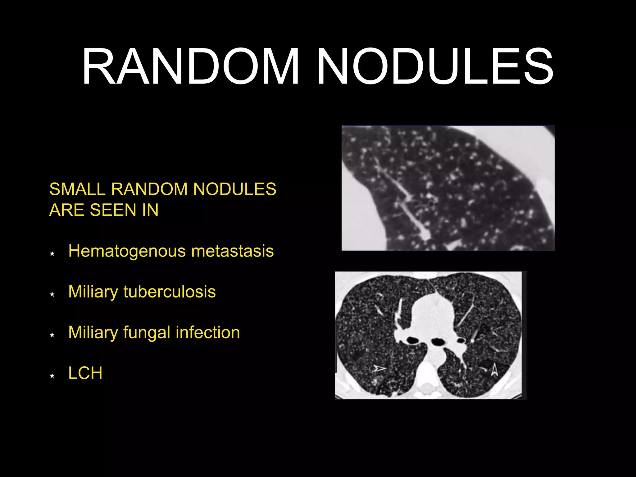 Patterns in HRCT chest | PPTX | Lung and Respiratory Health | Diseases ...