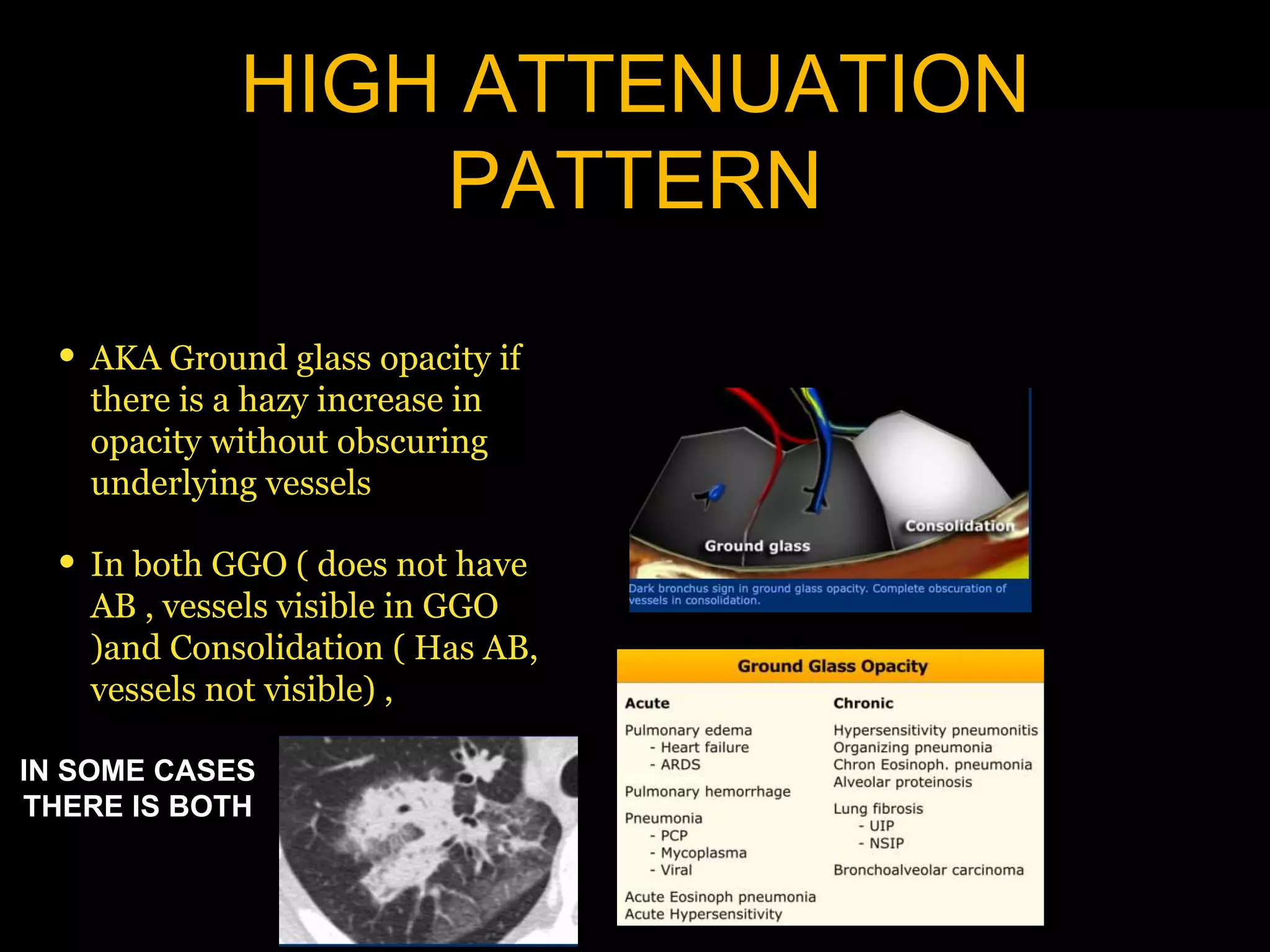 Patterns in HRCT chest | PPTX | Lung and Respiratory Health | Diseases ...