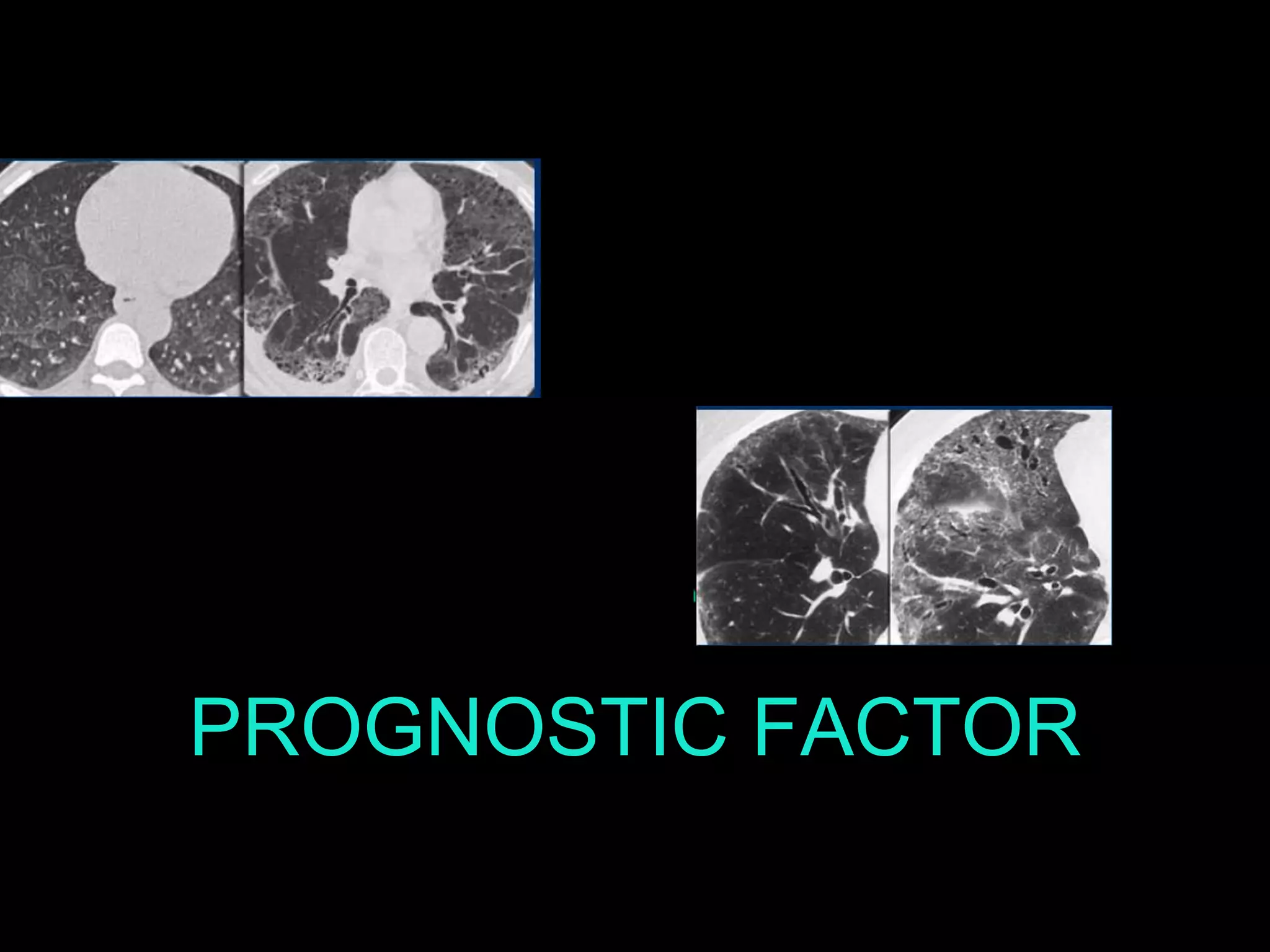 Patterns In Hrct Chest Pptx Lung And Respiratory Health Diseases And Conditions