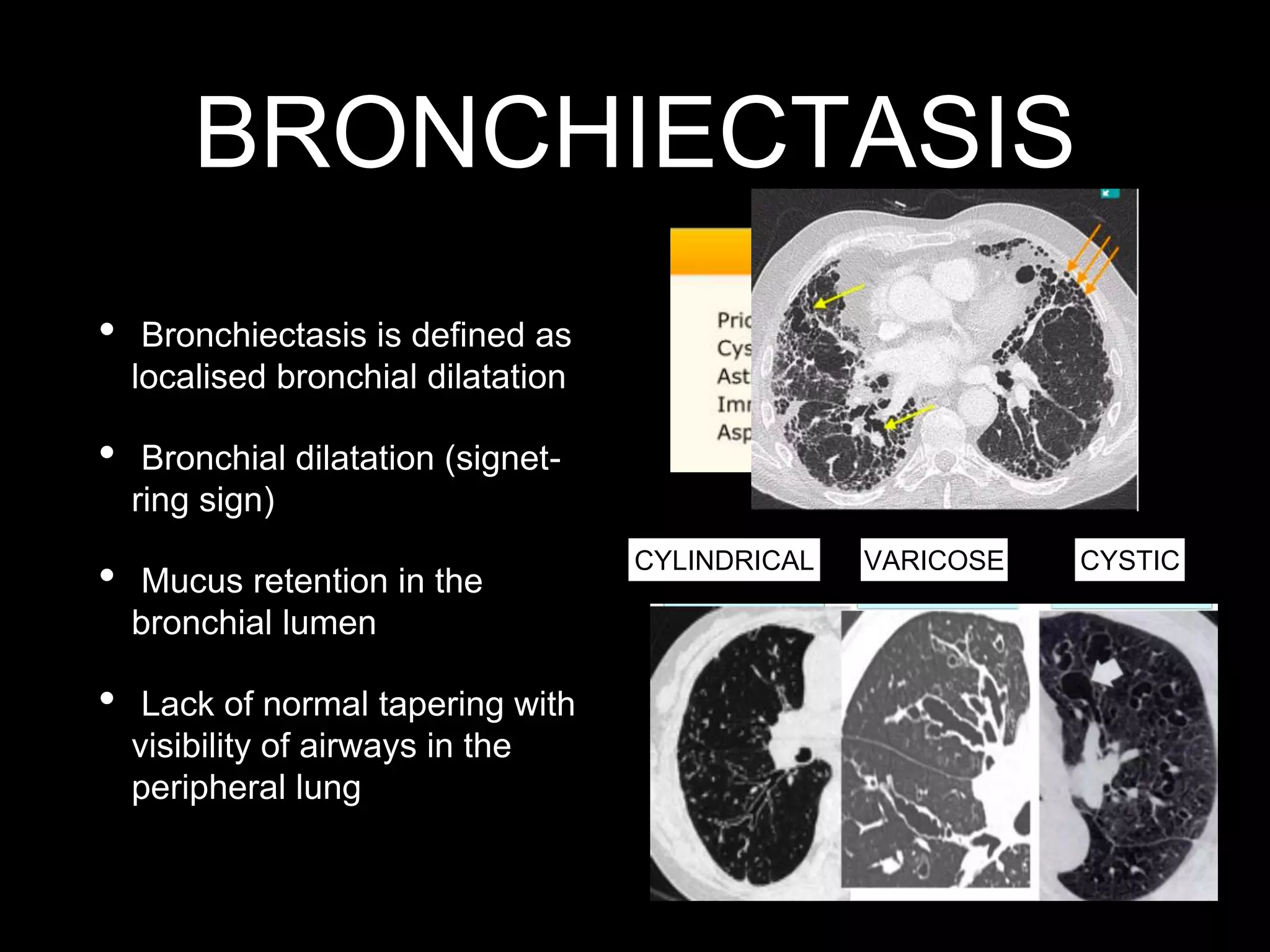 Patterns in HRCT chest | PPTX