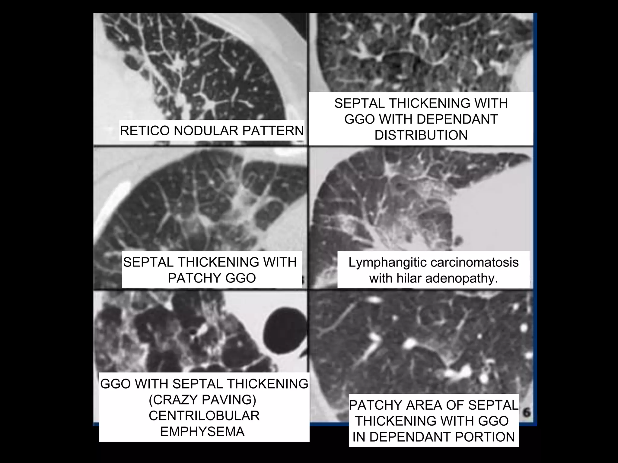 Patterns in HRCT chest | PPTX