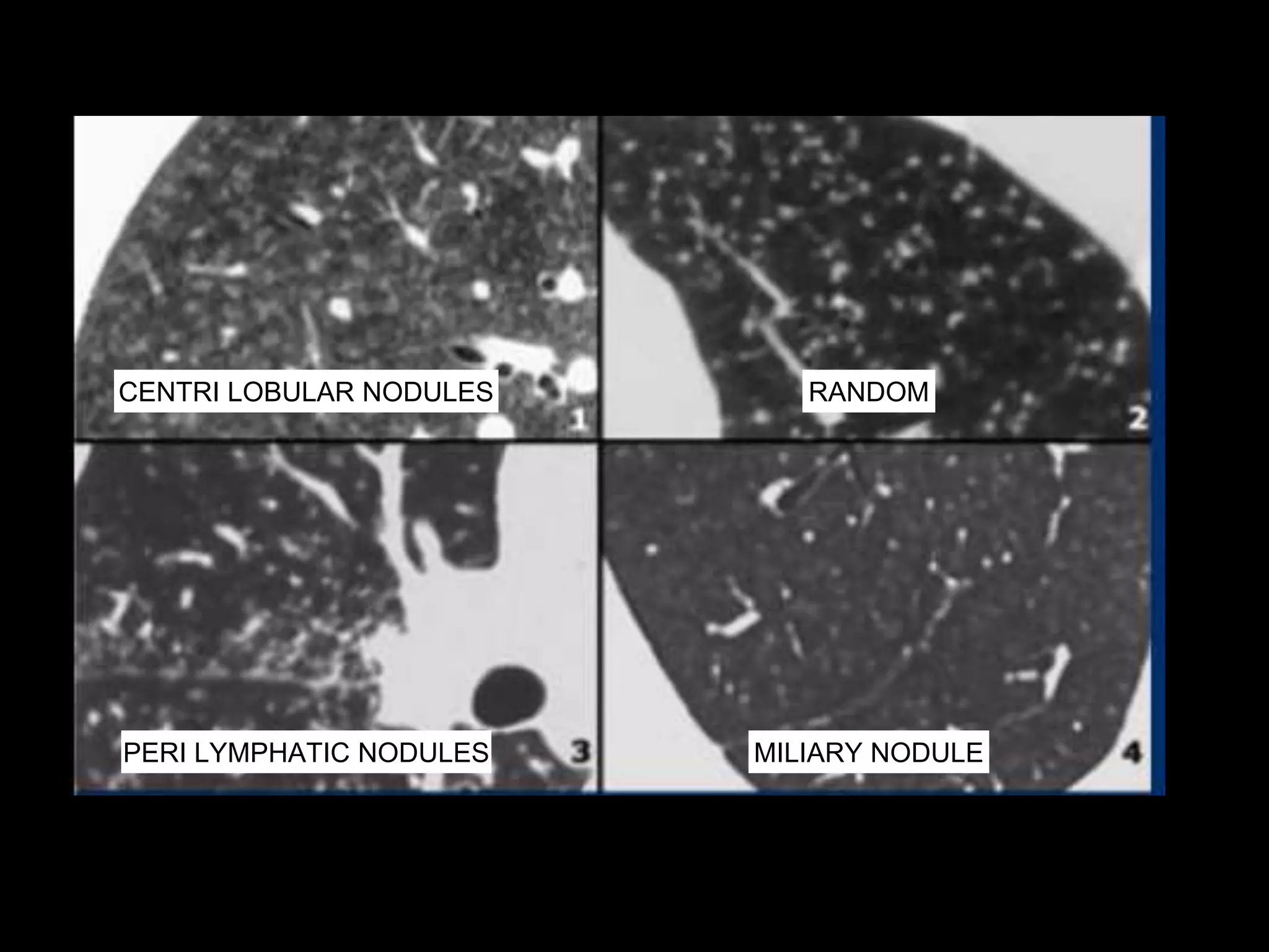 Patterns in HRCT chest | PPTX | Lung and Respiratory Health | Diseases ...