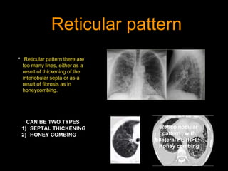 Patterns in HRCT chest | PPTX